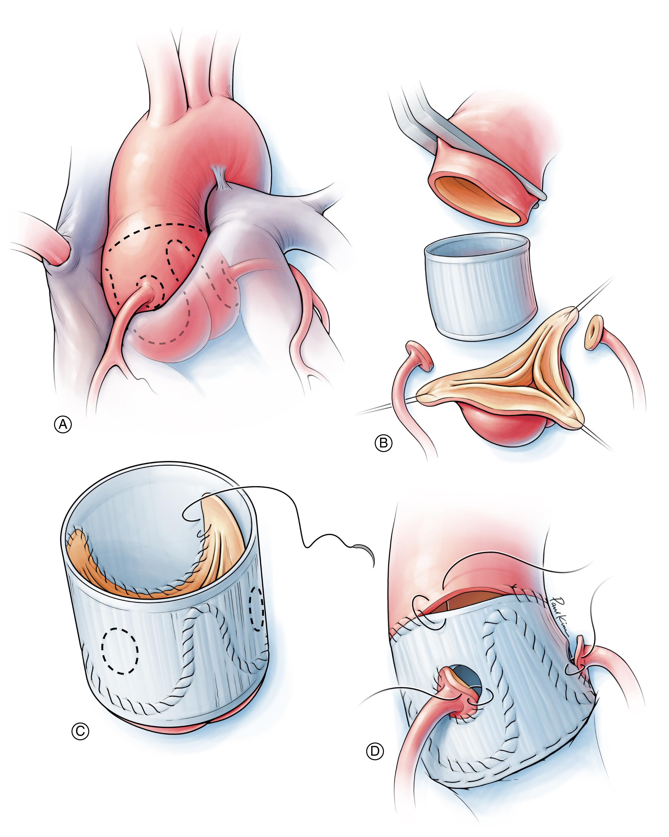 aortic root sparing surgery