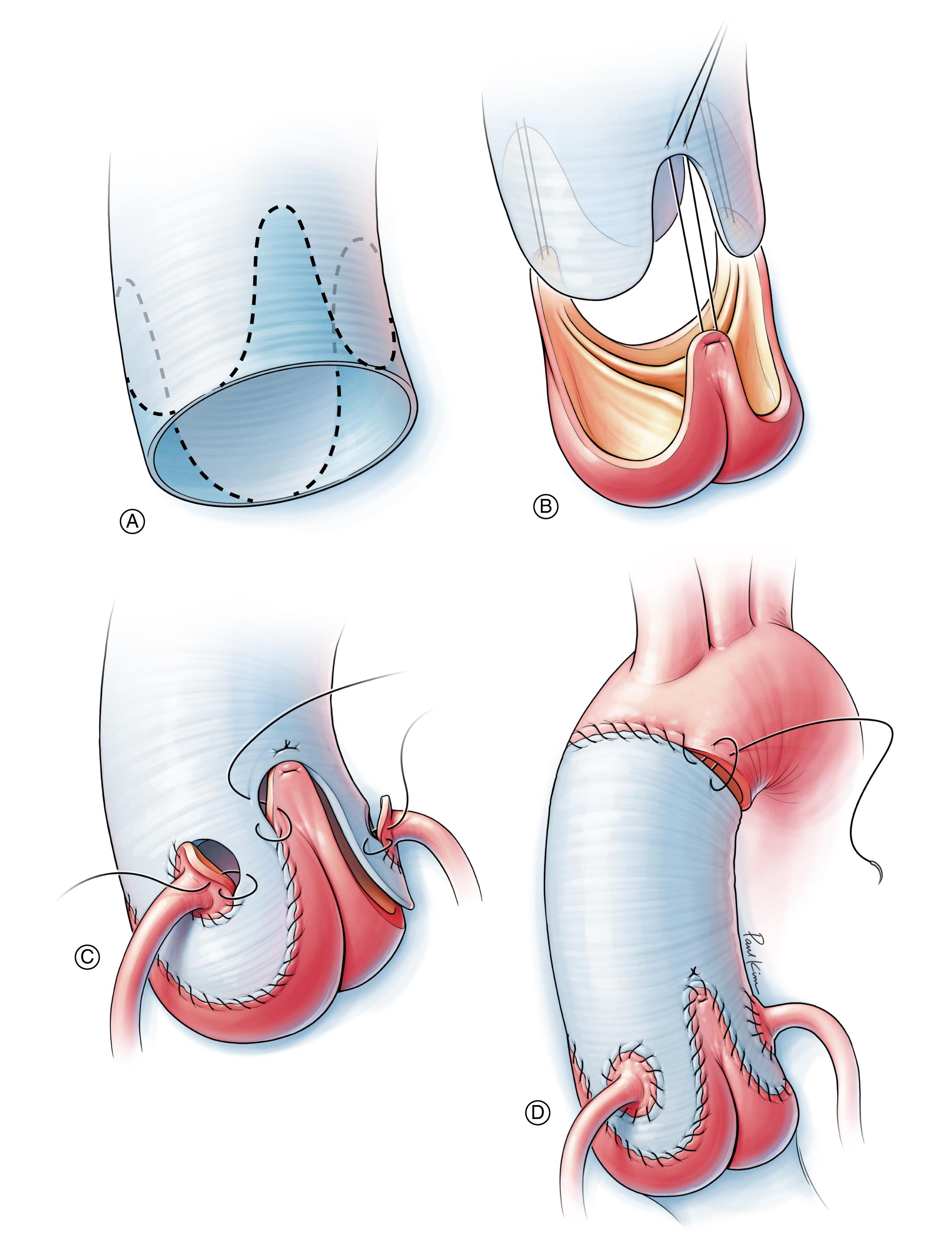 aortic root sparing surgery