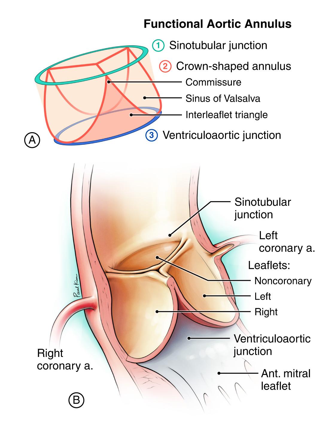 sinotubular junction aorta