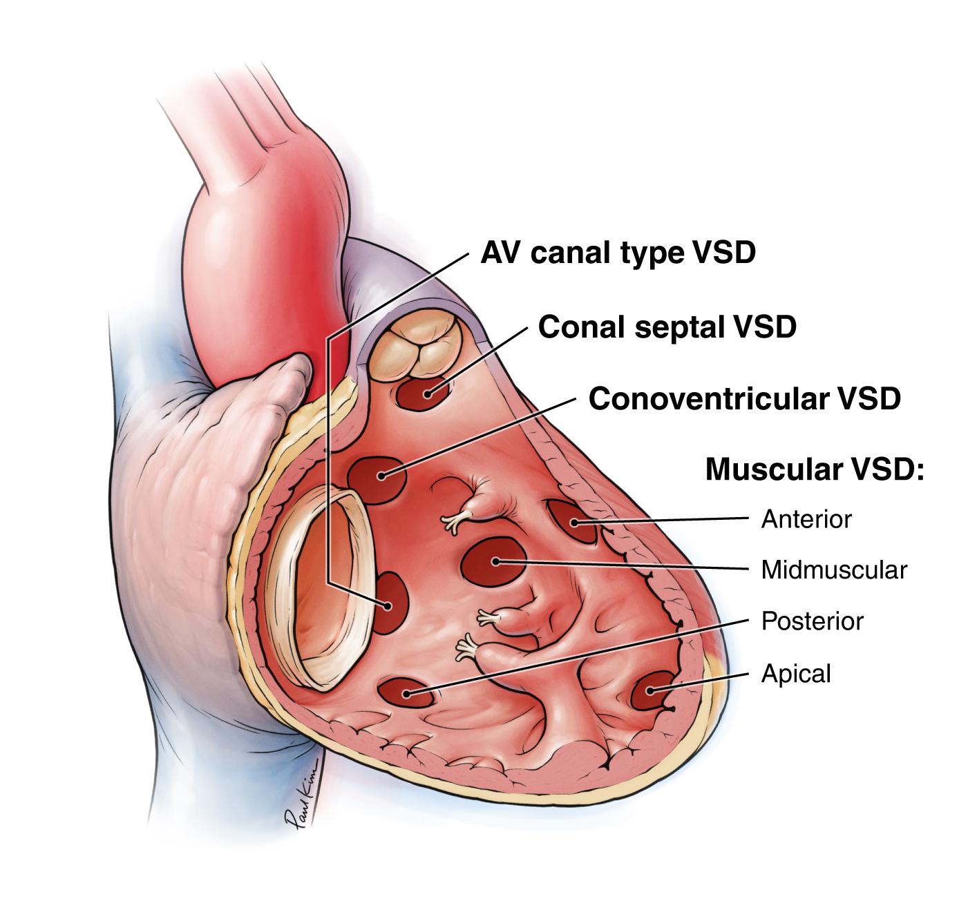 av canal defect types