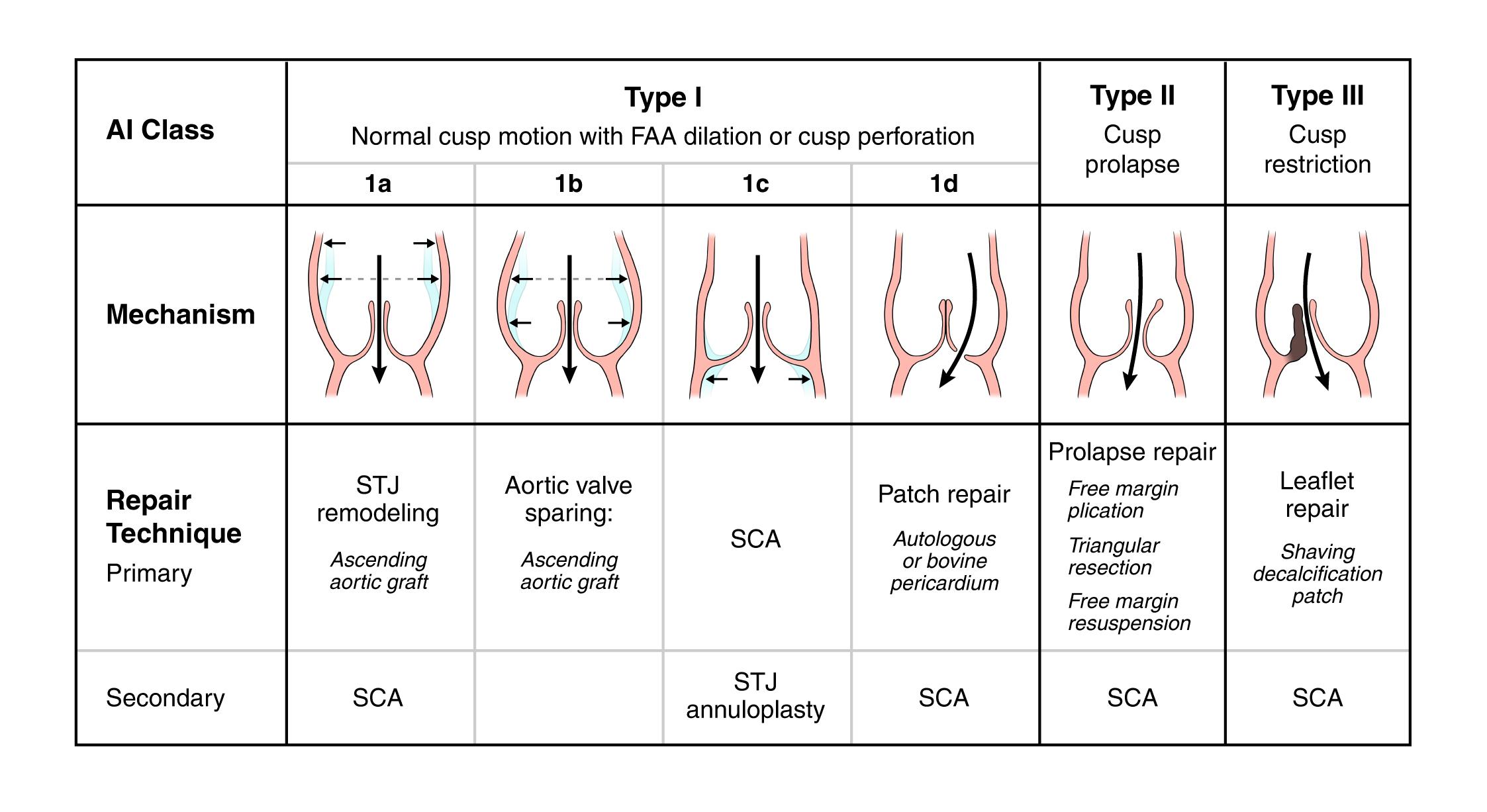 aortic valve leaflets names