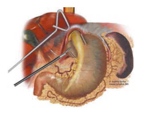 partial fundoplication types