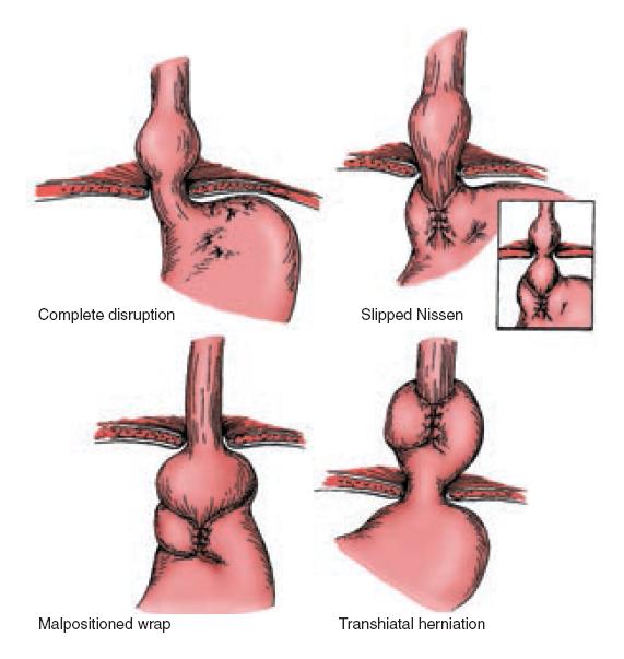 partial fundoplication side effects