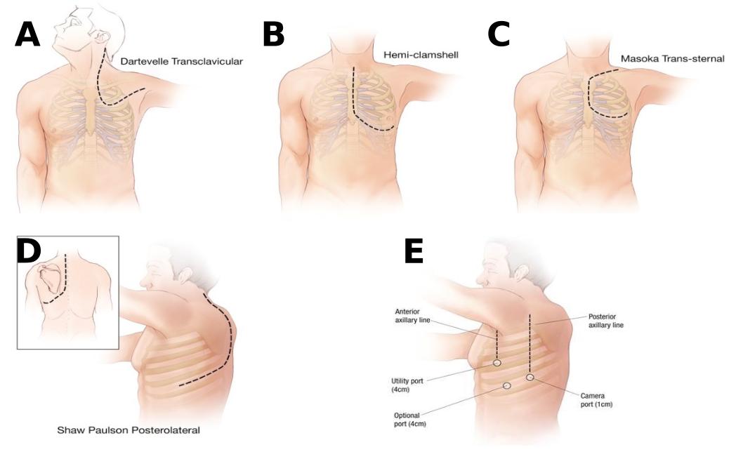 clamshell surgery incision